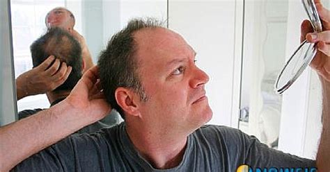 대머리 고민 이제 그만獨 연구진 사상최초 인공 모낭 배양 성공