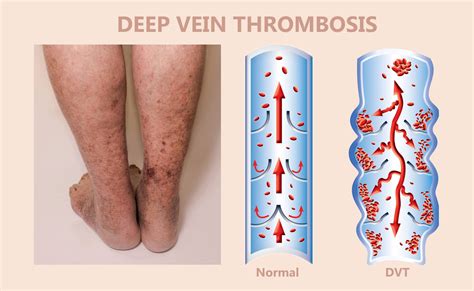 Deep Vein Thrombosis Dvt Vein Specialist Of The Carolinas