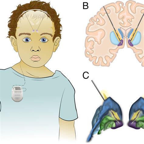 Pdf An Open Label Prospective Pilot Trial Of Nucleus Accumbens Deep