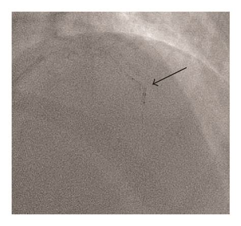 Successful Pci Of Lad After Using Gbat Technique A Predilation Of Download Scientific