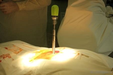 Перкутанный транспедикулярный спондилодез | Нейрохирургия