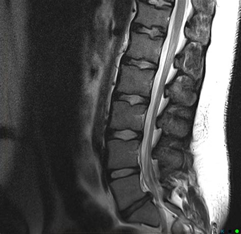 Mri Spine Paediatic Mri Series