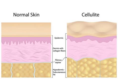 Cellulite Vs Lipedema