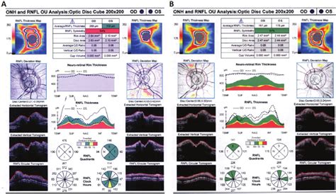Oct Rnfl Findings Cirrus Oct Rnfl Thickness Before A And After B Download Scientific