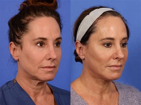 Bad Face Lifts Facelift Before And After Photos Prove Just How Natural