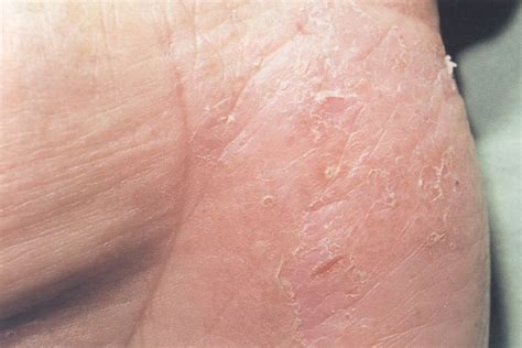 雙手搔癢脫屑，汗皰疹、富貴手、手癬的差異？ 20skin美醫集團 「二林皮膚科四季診所」