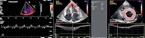 A Tissue Doppler Imaging Evaluation Of The Lv Lateral Wall Showing