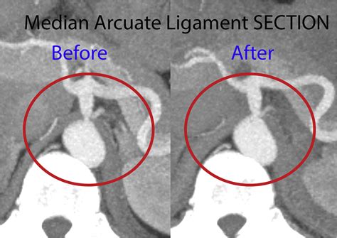 Hybrid Laparoscopic And Endovascular Treatment For Median Arcuate