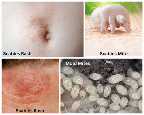 Scabies Rash