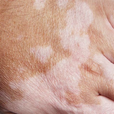 What Is Mottled Skin And Is It Dangerous For You Avkiu