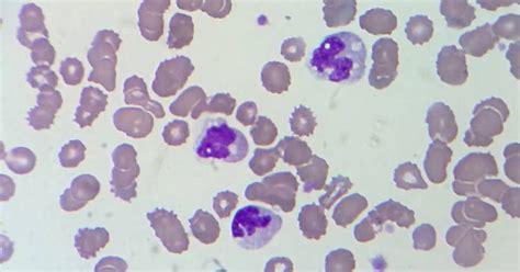 Veterinary Hematology Dextervet Vacuolated Monocytes Septicemia