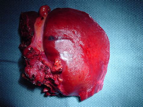 Cholangiohepatitis Surgery Photos