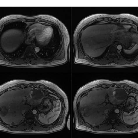 A Follow Up Liver Dynamic Magnetic Resonance Imaging In April 2020 Download Scientific Diagram