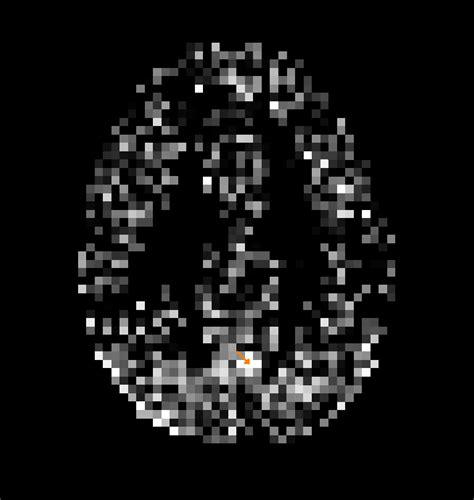 Correlation Map And Posterior Connectivity Map Between Seed Voxel And