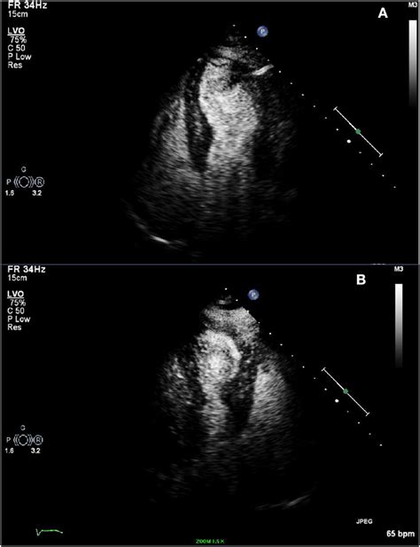 Ab Transthoracic Echocardiogram With Definity Contrast