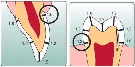 Emax Vs Zirconia Who Deserves The Crown