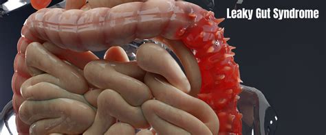 Leaky Gut Syndrome Numesa