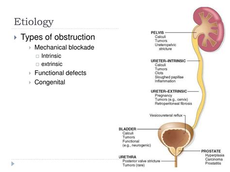 Ppt Urinary Tract Obstruction Powerpoint Presentation Free Download Id 1416458