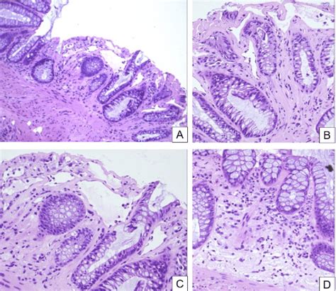 Radiation Induced Colitis A Crypt Distortion Dilation And Atrophy