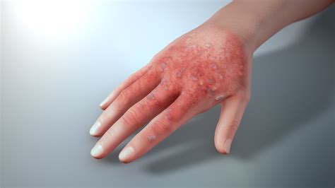 Actinic Keratosis Depicted Using 3d Medical Animation Still Shot