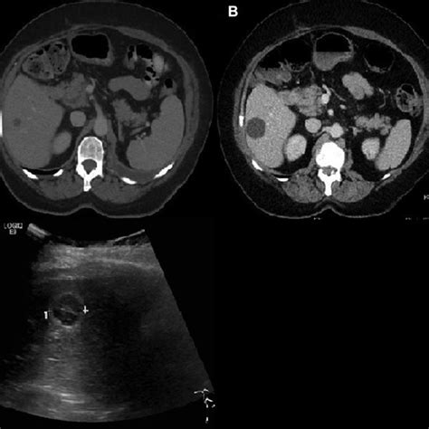 A Baseline Scan 12 Mm Segment Vi Hepatic Cyst B Scan At Month 26