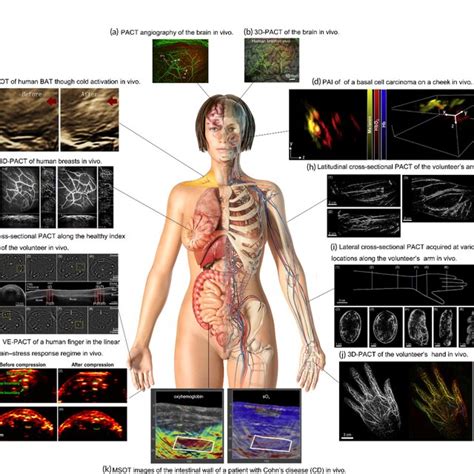 Photoacoustic Computed Tomography Pact Imaging Of Melanoma A B Download Scientific Diagram