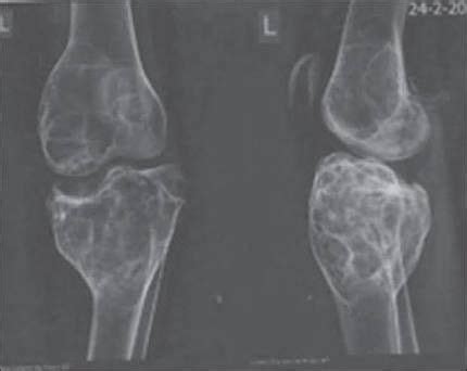 Osteitis Fibrosa Cystica X Ray