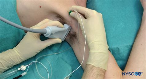 Ultrasound Guided Axillary Brachial Plexus Block Nysora