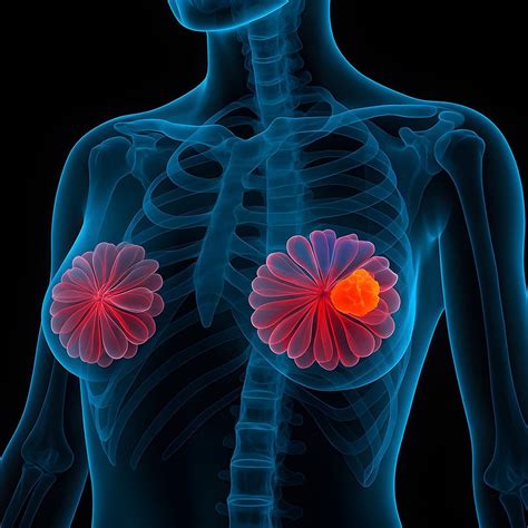 Breast Cancer Outcomes Can Be Predicted By Residual Cancer Burden