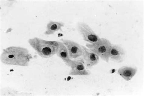 Anal Pap Smear Semantic Scholar