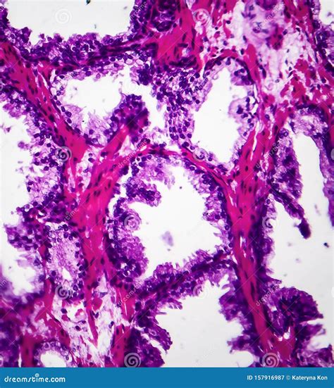 Benign Prostatic Hyperplasia Stock Image Image Of Analysis Microscopic 157916987