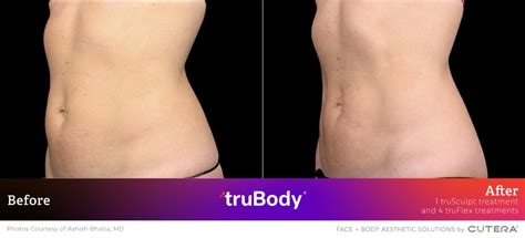 Trubody® Body Sculpting Tki