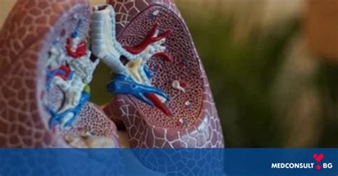 Какво представлява недребноклетъчният рак на белия дроб — Medconsult Bg