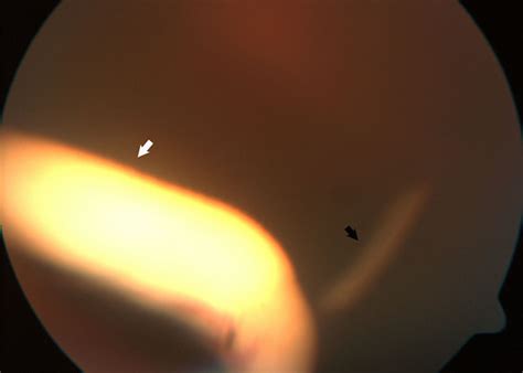 The Newly Injected Dexamethasone Implant White Arrow And The Download Scientific Diagram