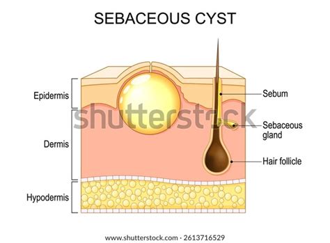 Sebaceous Cysts Over 97 Royalty Free Licensable Stock Illustrations