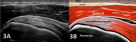 The Application Of Musculoskeletal Ultrasound In The Diagnosis Of Supraspinatus Injuries