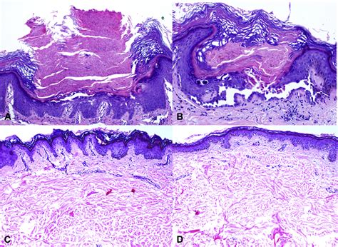 Clinicopathologic Findings Of Guttate Leukoderma In Darier Disease A