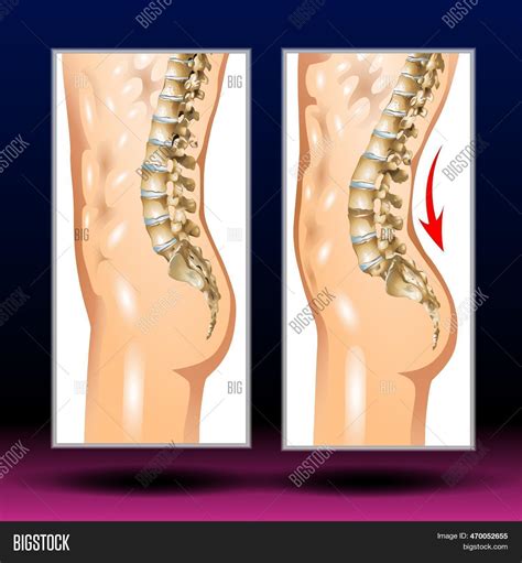 Spine Curves Spinal Image Photo Free Trial Bigstock