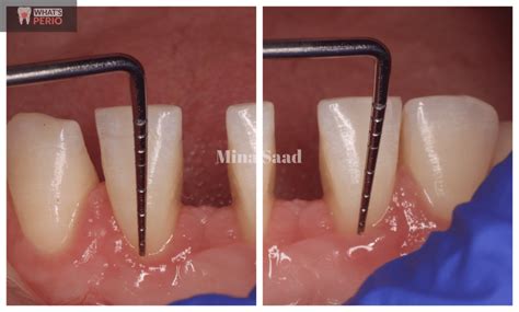 Partial Root Coverage For Miller Class Iii Gingival Recession Of