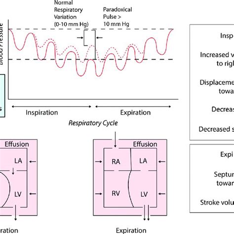 Jvp Tracing In Normal And Constrictive Pericarditis Download Scientific Diagram