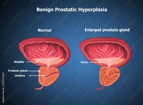 Benign Prostatic Hyperplasia Stock Illustration Adobe Stock