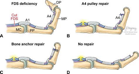 An Analysis Of Profundus Tendon Repairs After Distal Phalanx Amputation
