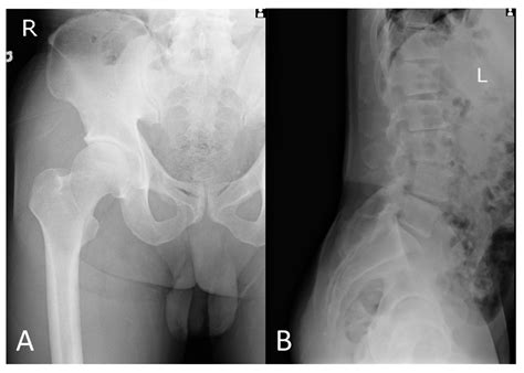 Ischial Spine X Ray