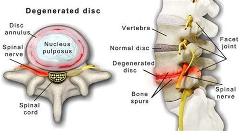 Understanding Degenerative Disc Disease Causes Symptoms And