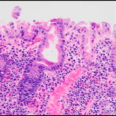 Histological Examination Of Jejunum Showing A Crypt Hyperplasia With