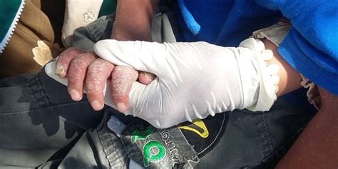 Mengenal Ichthyosis Kelainan Kulit Yang Lebih Tipis Dari Orang Normal