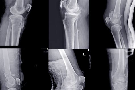 Knee Fracture In Gadchiroli Dr Bariks Orthocare Clinic
