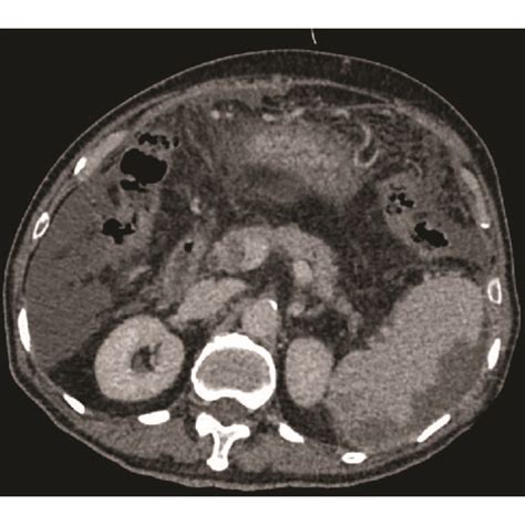 Endoscopic Findings Of Gastroesophageal Varices Igv Type 1 And F3gov
