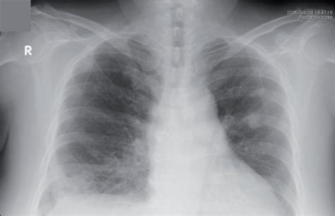 Case 1 Cxr Em Bits