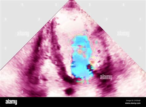 Ischemic Mitral Insufficiency Mi Pathology Of The Left Ventricle